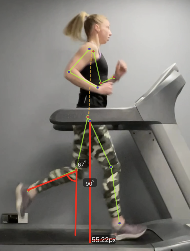Stress Fractures/Shin Splints – Lincs Injury Clinic
